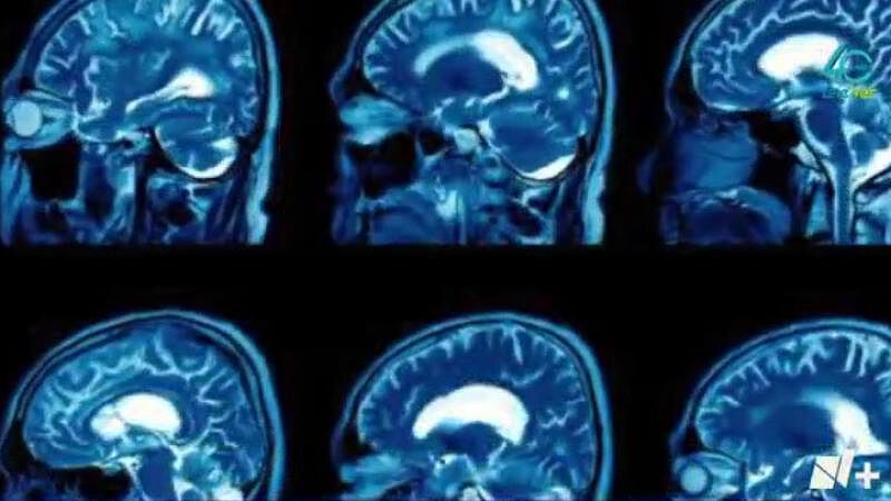 Día Mundial de la Encefalitis ¿Cuáles son sus Síntomas? | N+